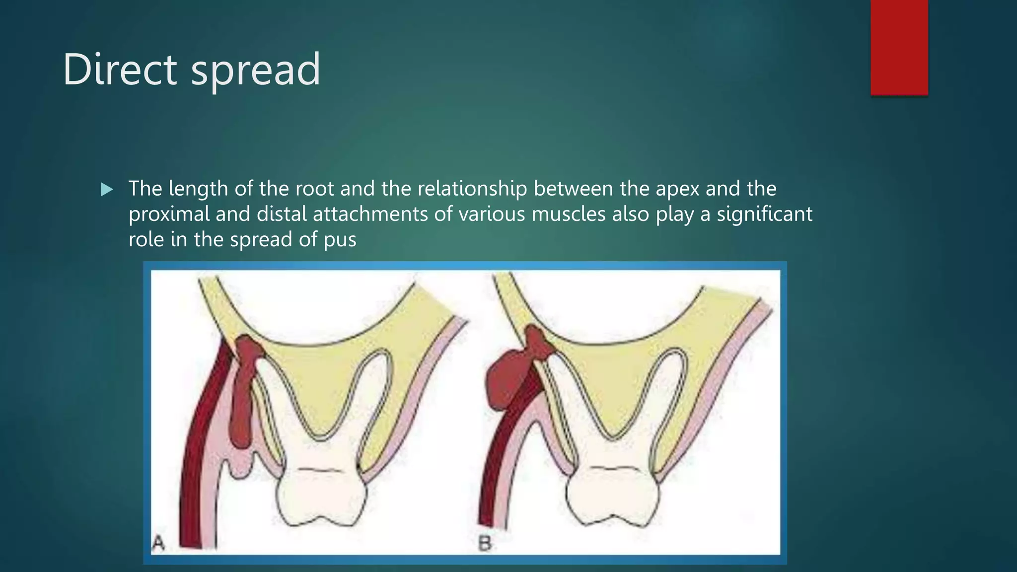 Infections of the facial spaces.pptx