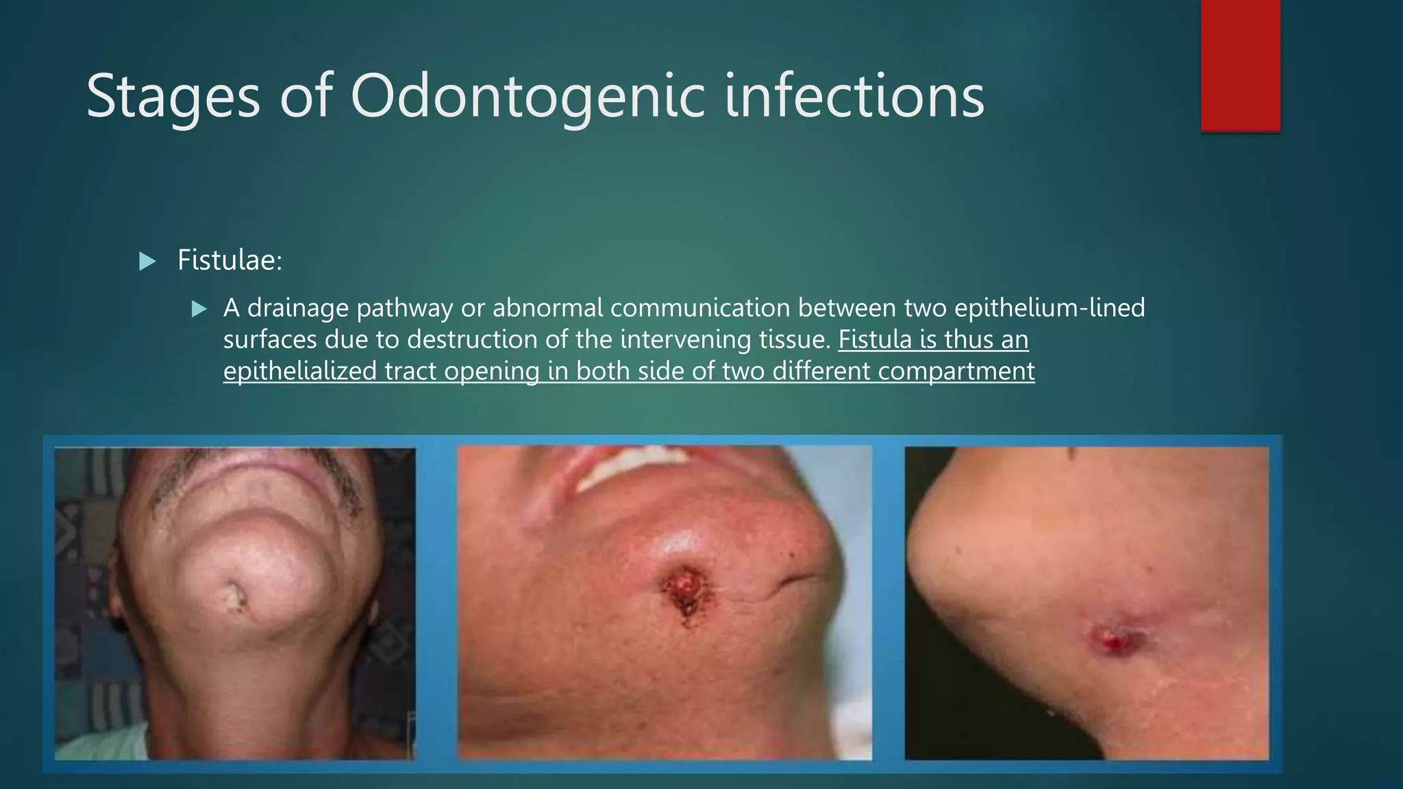 Infections of the facial spaces.pptx