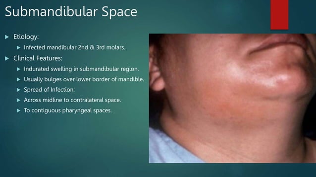 Infections of the facial spaces.pptx | Ear, Nose and Throat Conditions ...
