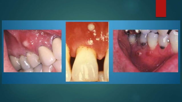 Infections of the facial spaces.pptx | Ear, Nose and Throat Conditions ...
