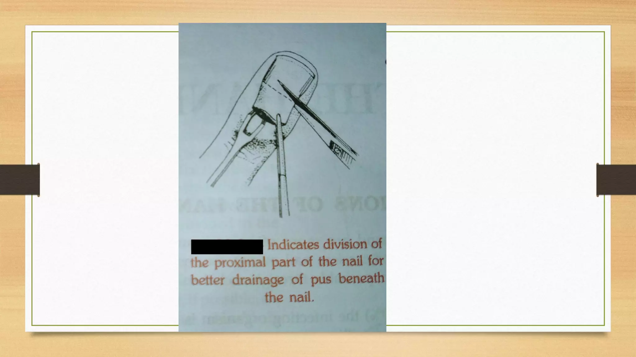 Infections of the hand | PPT