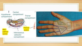 Infections of the hand | PPT