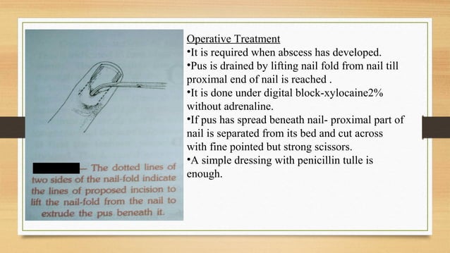 Infections of the hand | PPT