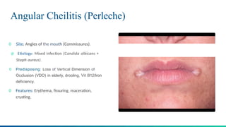 Infections of the Oral Cavity - COMPREHENSIVE REVIEW | PPTX