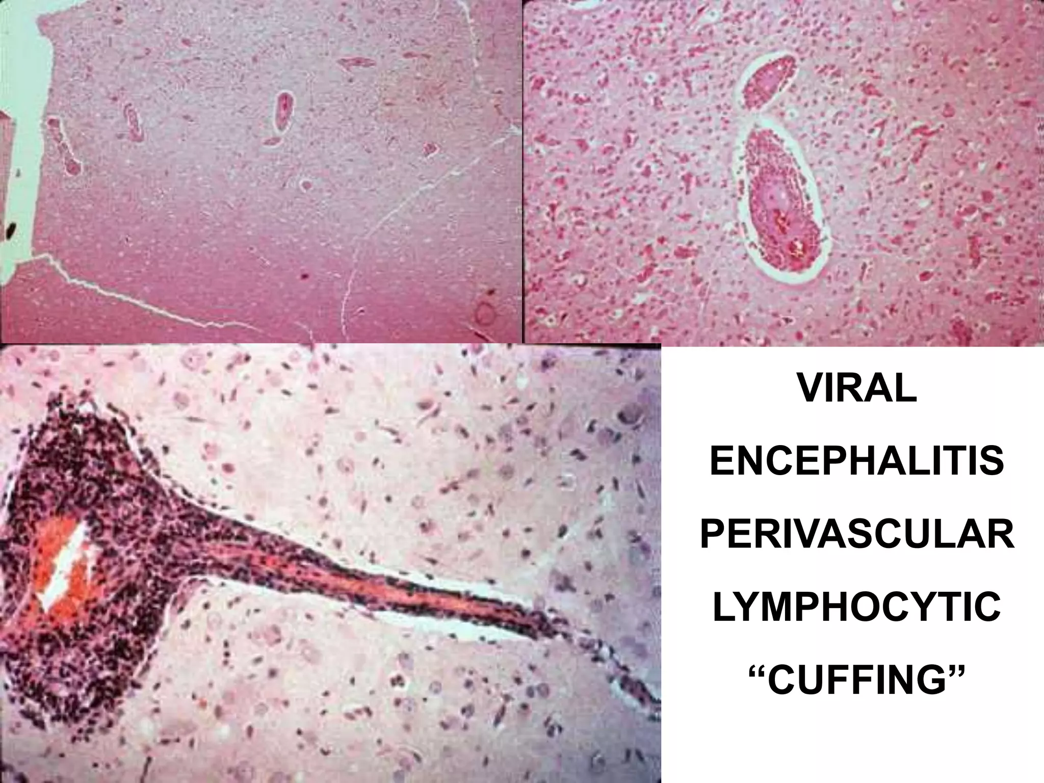 Infectious CNS diseases | PPTX