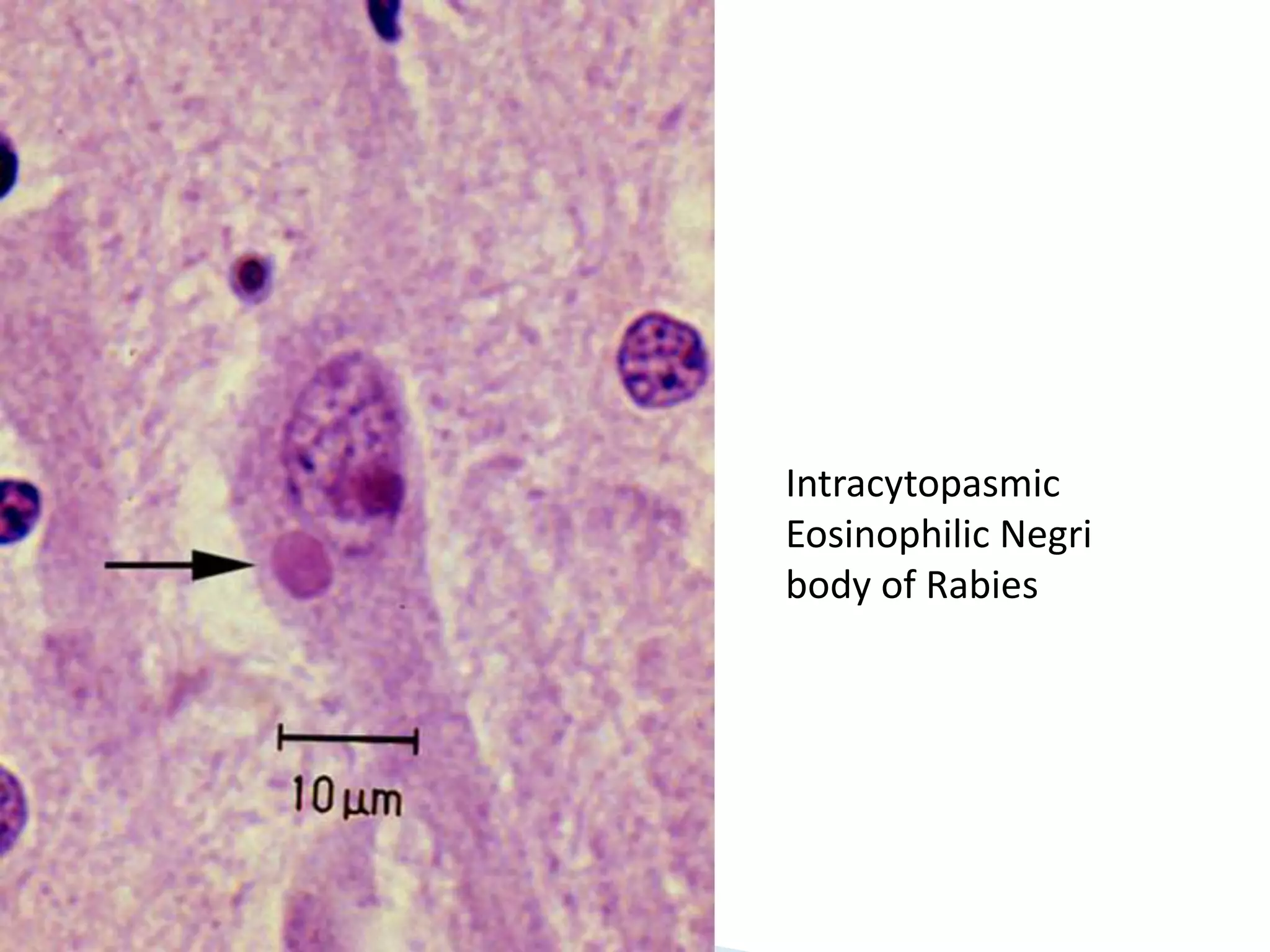 Infectious CNS diseases | PPTX