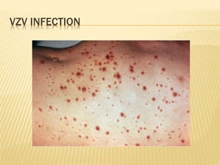 Infectious cutaneous manifestation of HIV | PPTX
