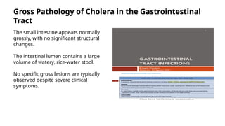 Infectious Disease Cholera Histopathology, Pathanatomy.pptx
