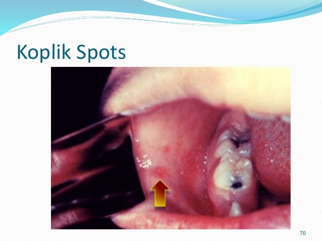 Infectious disease in children nurs 3340