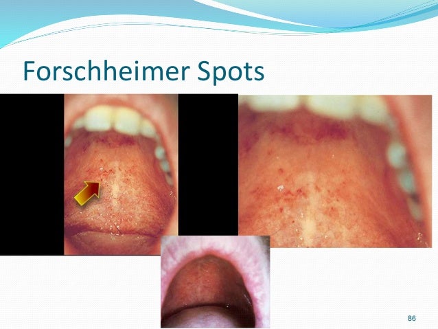 Nagayama Spots Roseola (Human Herpes Viruses 6 And 7) | Obgyn Key