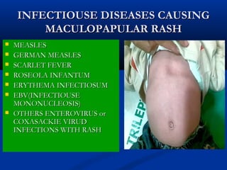 Maculopapular Rash With Infectious Mononucleosis