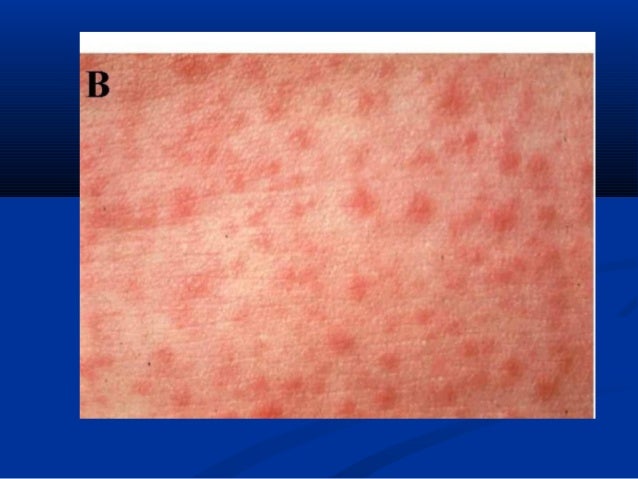 Infectious disease skin rash