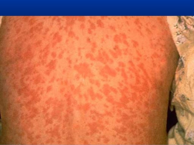 Infectious disease skin rash