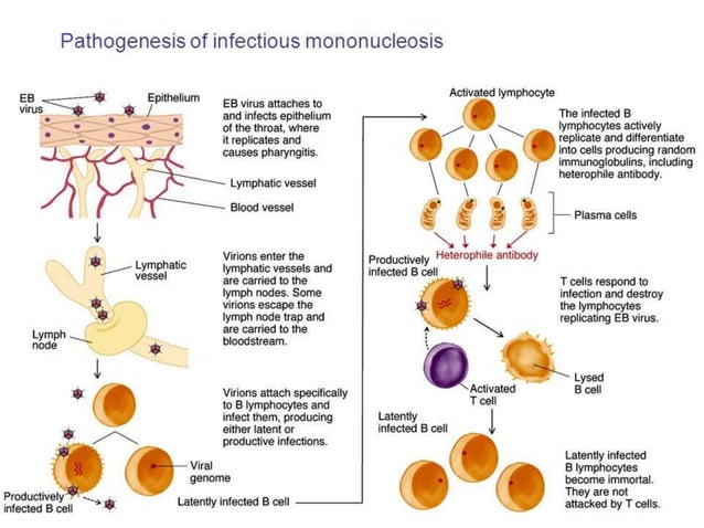 Infectious Mononucleosis - Pathology | PPTX | Blood Disorders ...