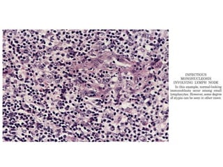 Infectious Mononucleosis - Pathology | PPTX