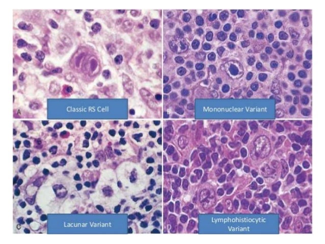 Infectious Mononucleosis - Pathology