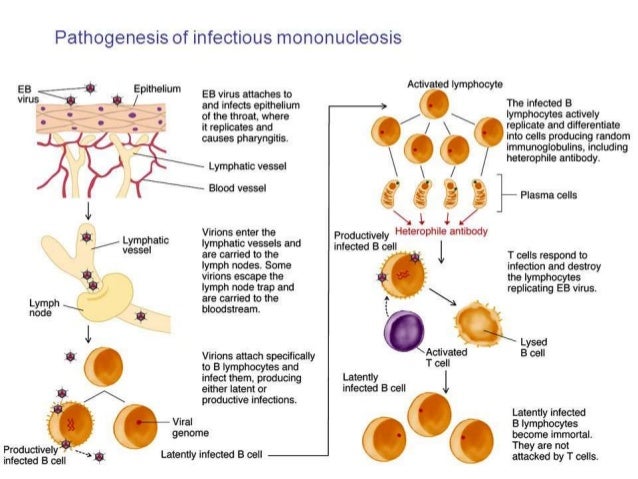 Infectious Mononucleosis - Pathology