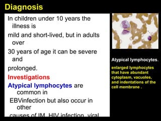 Atypical Lymphocytes Infectious Mononucleosis