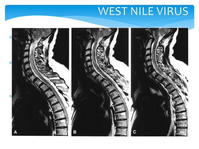 Infectious Myelopathies P.pptx