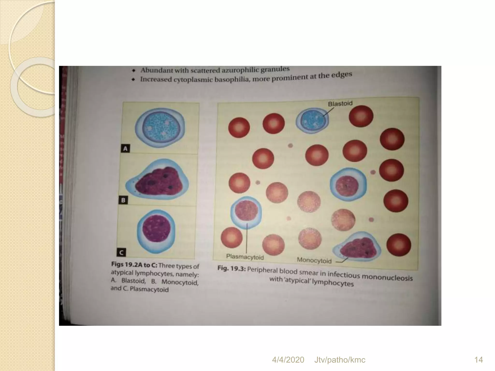 Infectious nucleosis jtvpathokmc | PPTX