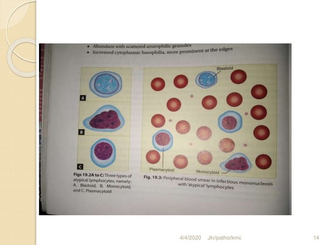 Infectious nucleosis jtvpathokmc | PPT