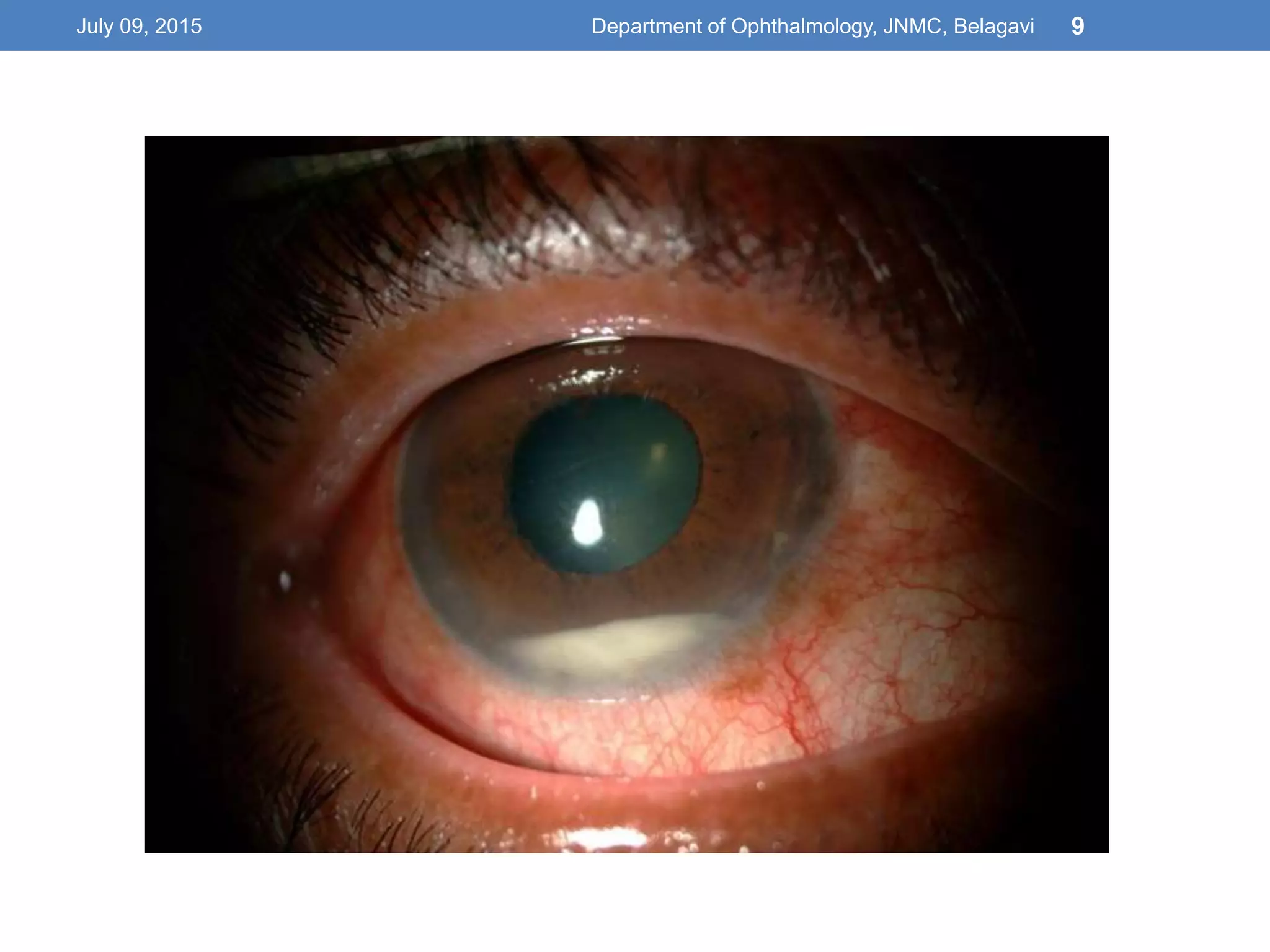 Infectious uveitis | PPTX