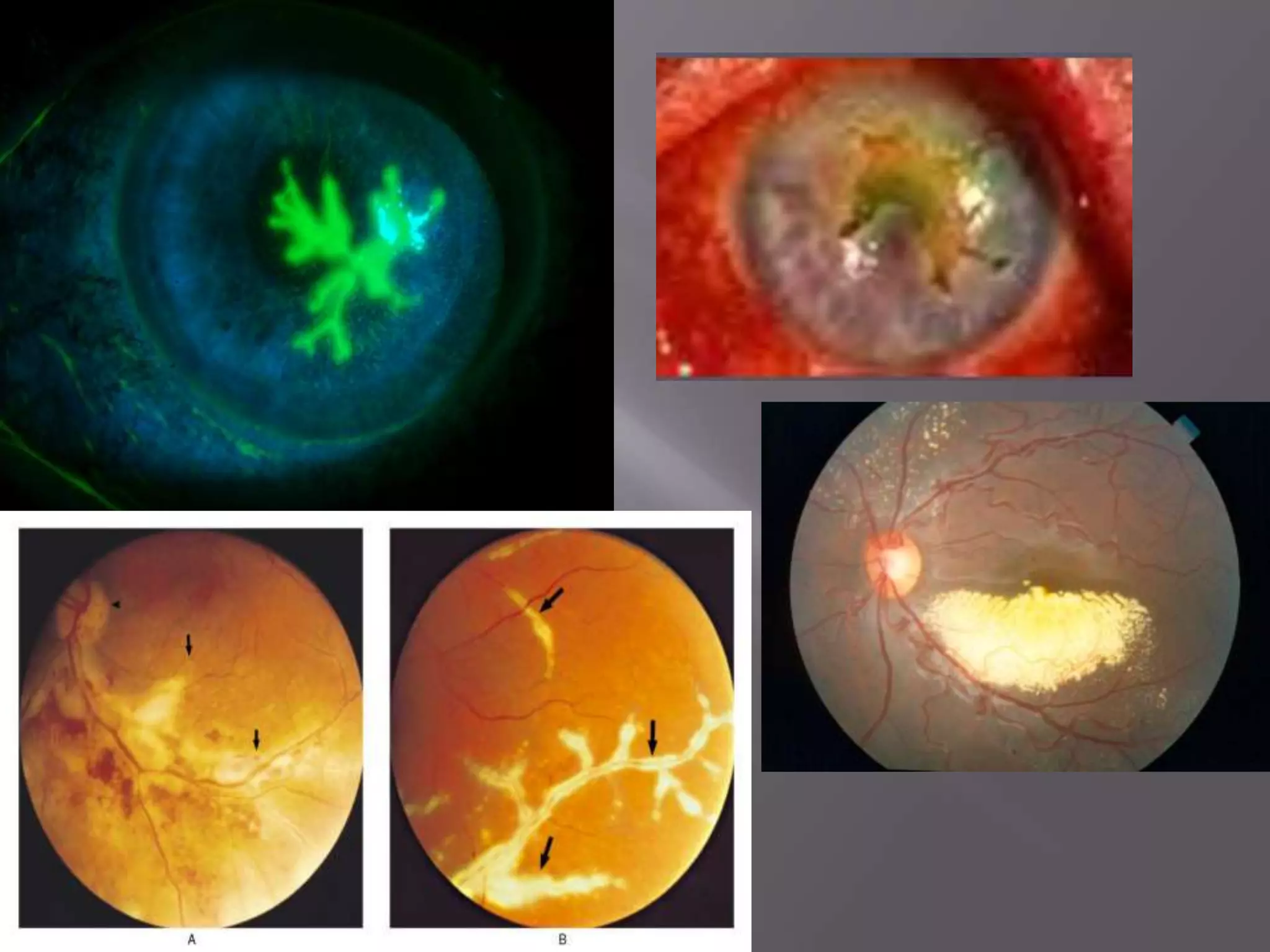 Infectious uveitis | PPTX | Eye and Vision Conditions | Diseases and ...