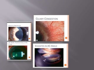 Infectious uveitis | PPTX