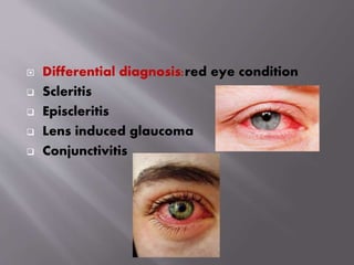 Infectious uveitis | PPTX