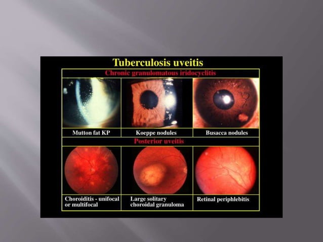 Infectious uveitis | PPTX | Eye and Vision Conditions | Diseases and Conditions