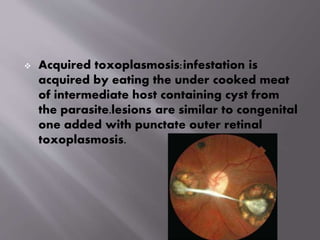 Infectious uveitis | PPTX