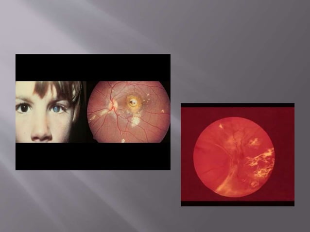 Infectious uveitis | PPTX | Eye and Vision Conditions | Diseases and ...