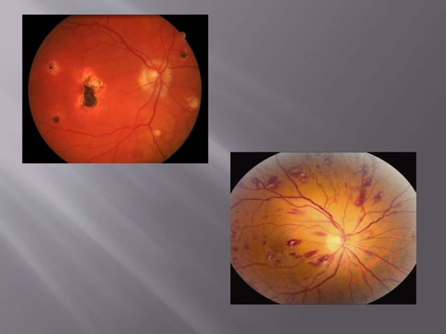 Infectious uveitis | PPTX | Eye and Vision Conditions | Diseases and ...
