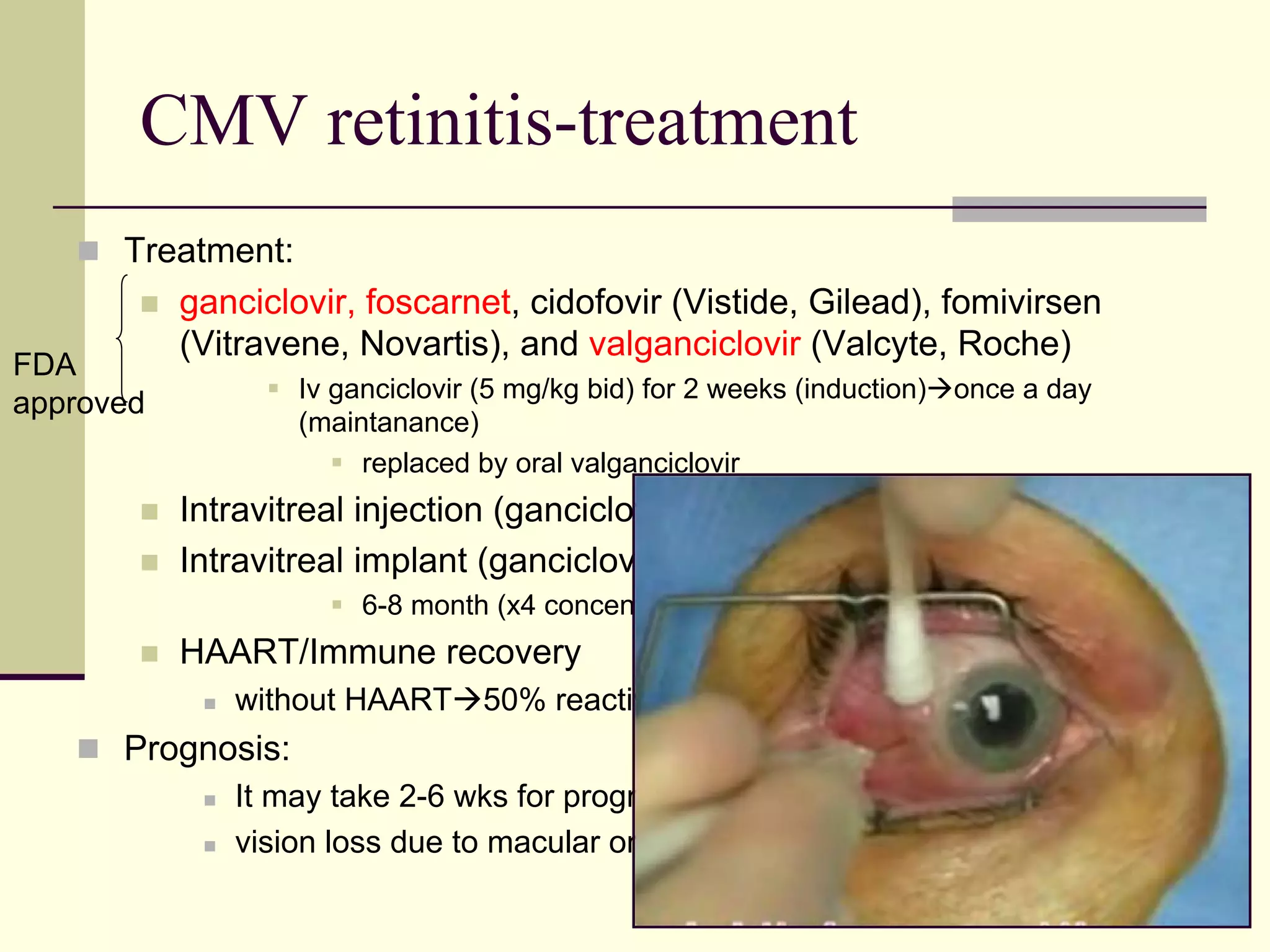 Infectious uveitis dr martinez (1) | PDF