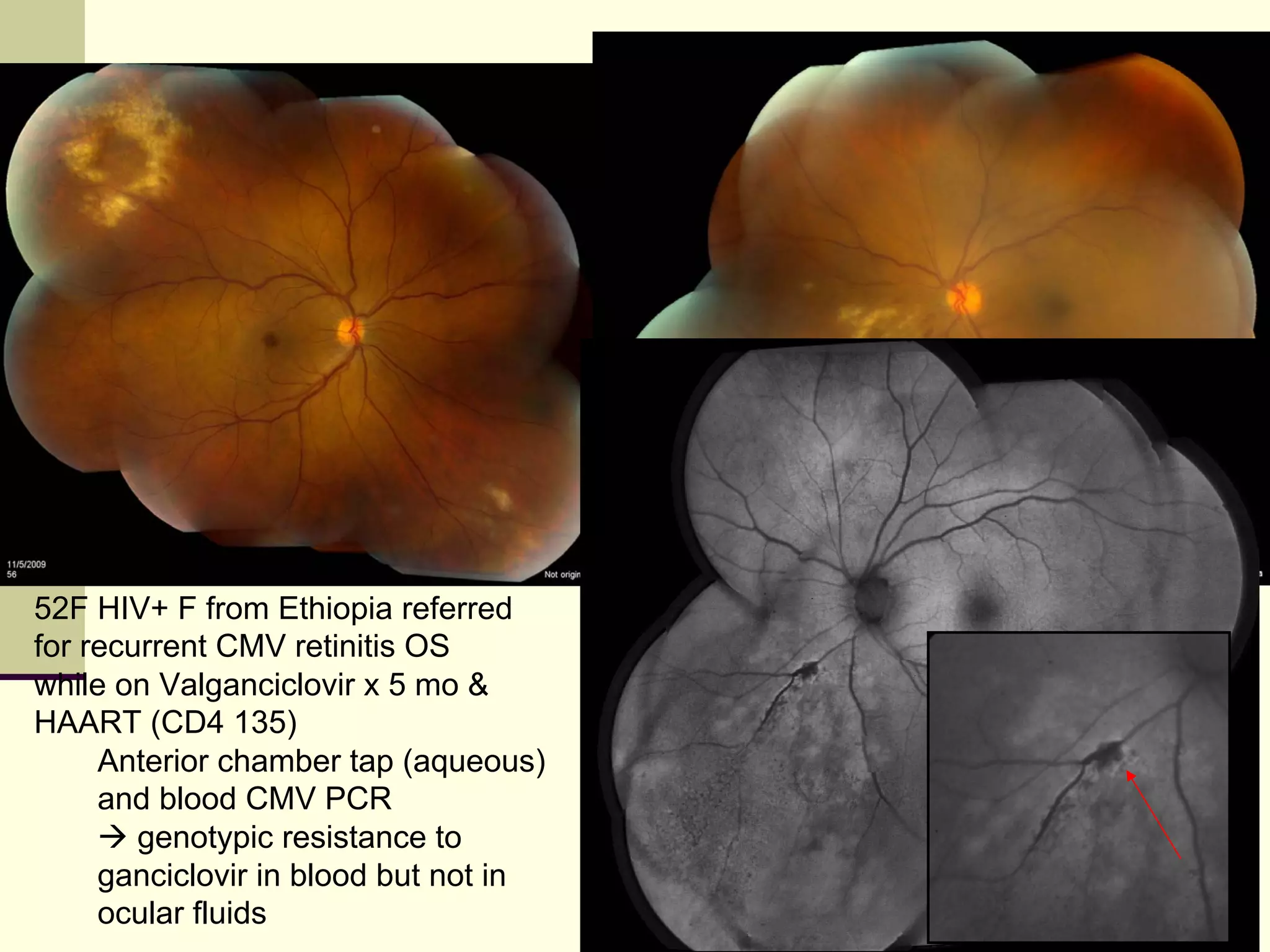 Infectious uveitis dr martinez (1) | PDF