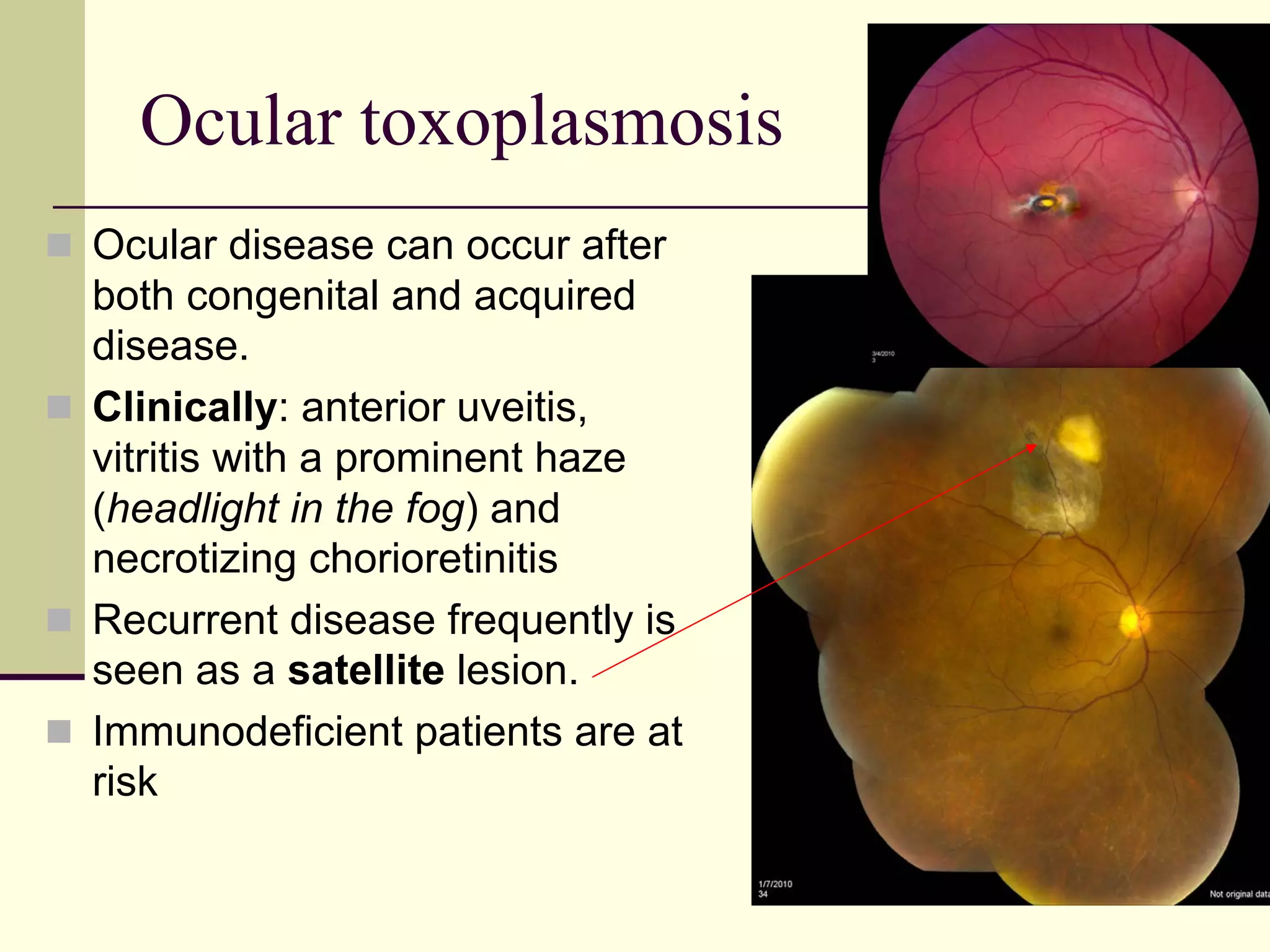 Infectious uveitis dr martinez (1) | PDF