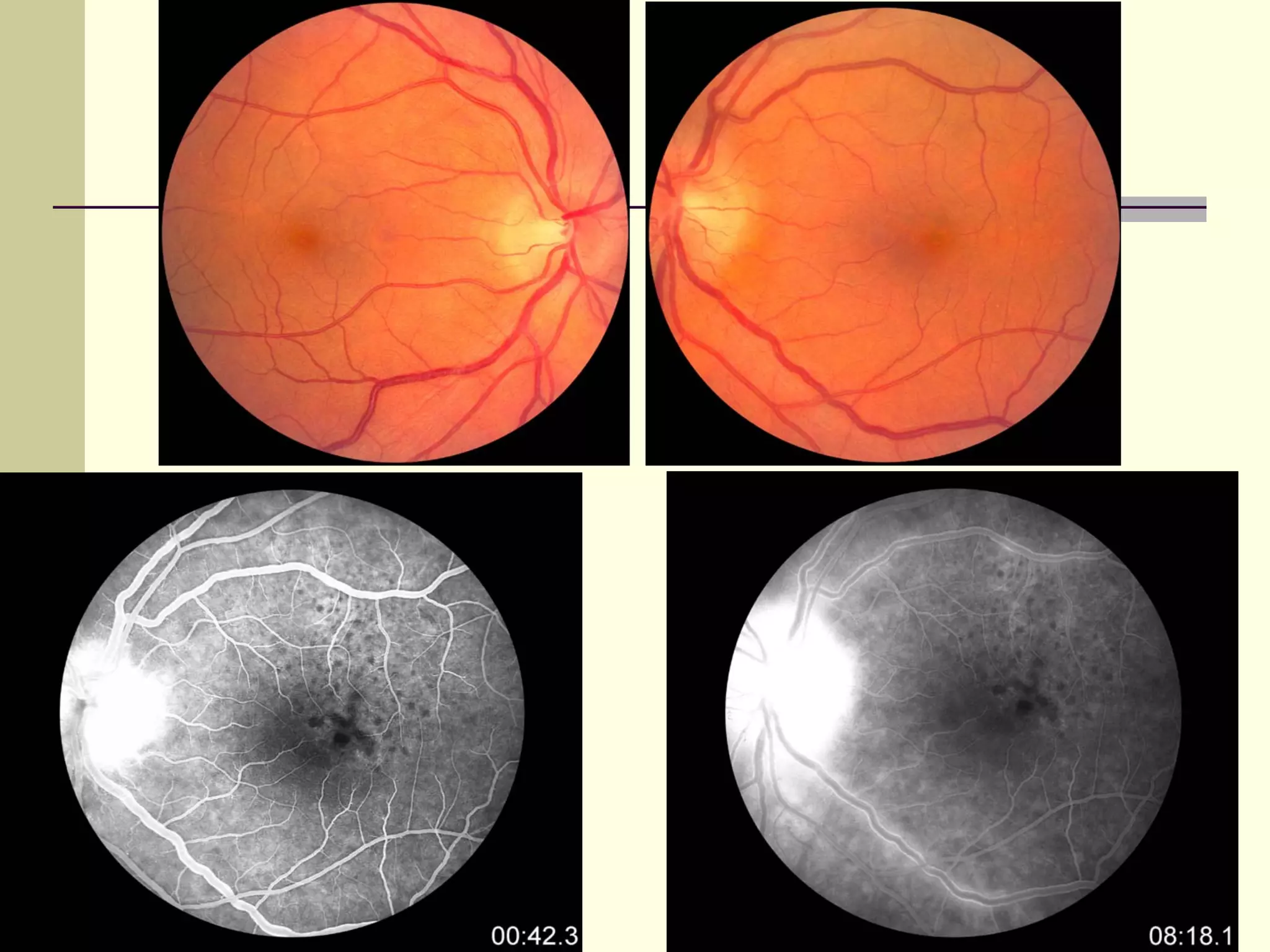 Infectious uveitis dr martinez (1) | PDF