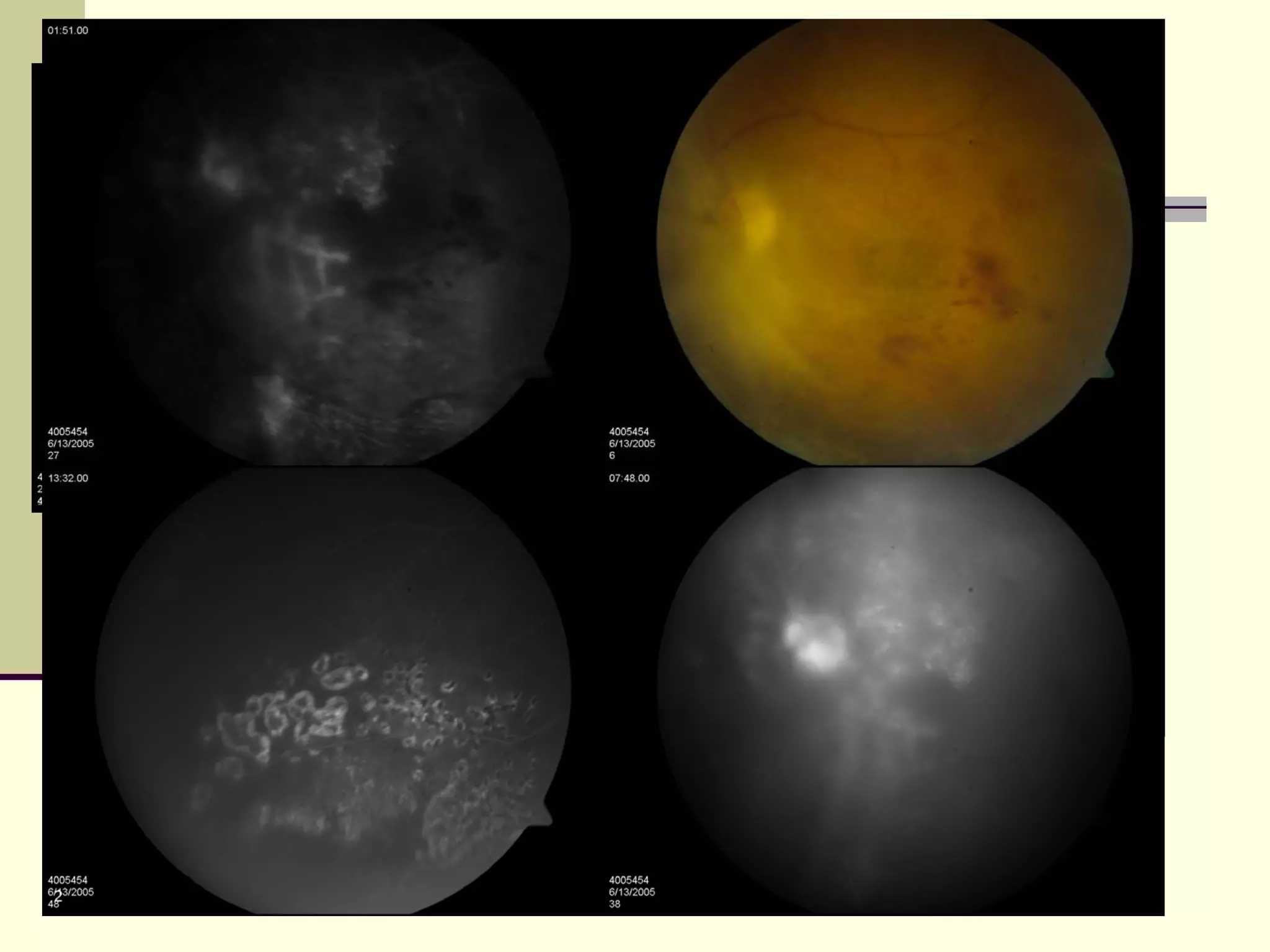 Infectious uveitis dr martinez (1) | PDF