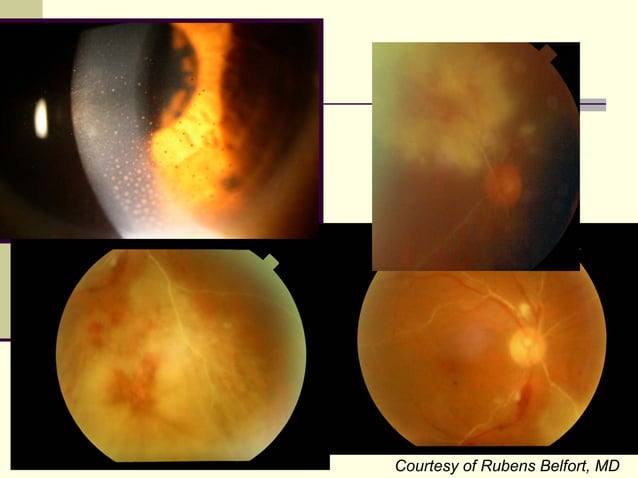 Infectious uveitis dr martinez (1) | PDF | Eye and Vision Conditions ...