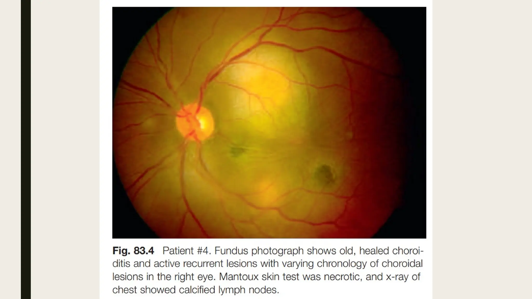 Infectious Uveitis Part 1 Pptx Ppt Upload Pptx