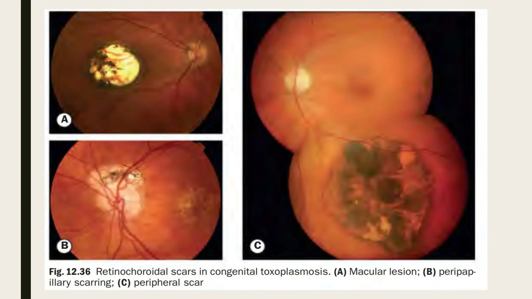 Infectious Uveitis Part 1 Pptx Ppt Upload Pptx