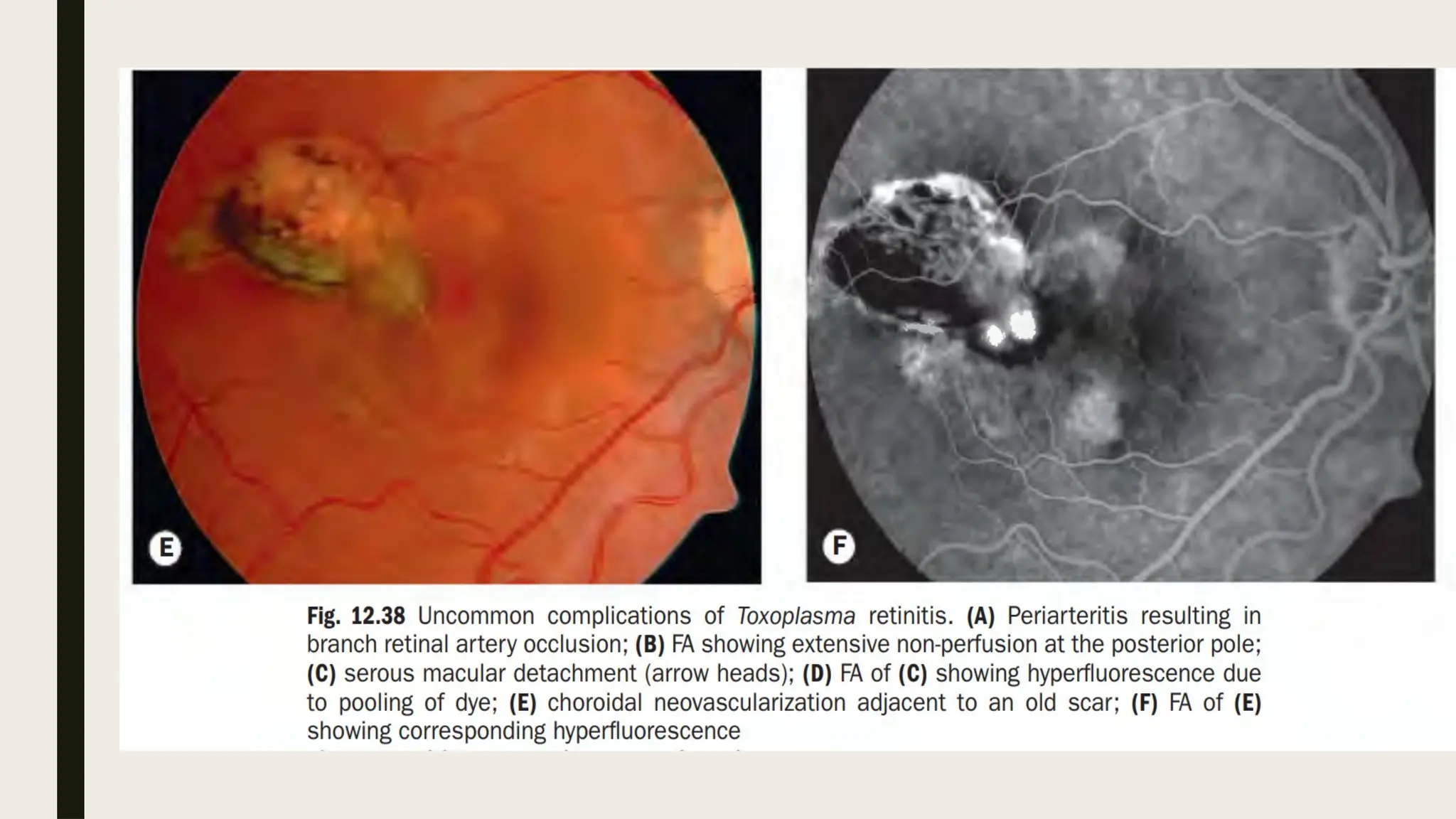 Infectious Uveitis Part 1 Pptx Ppt Upload Pptx