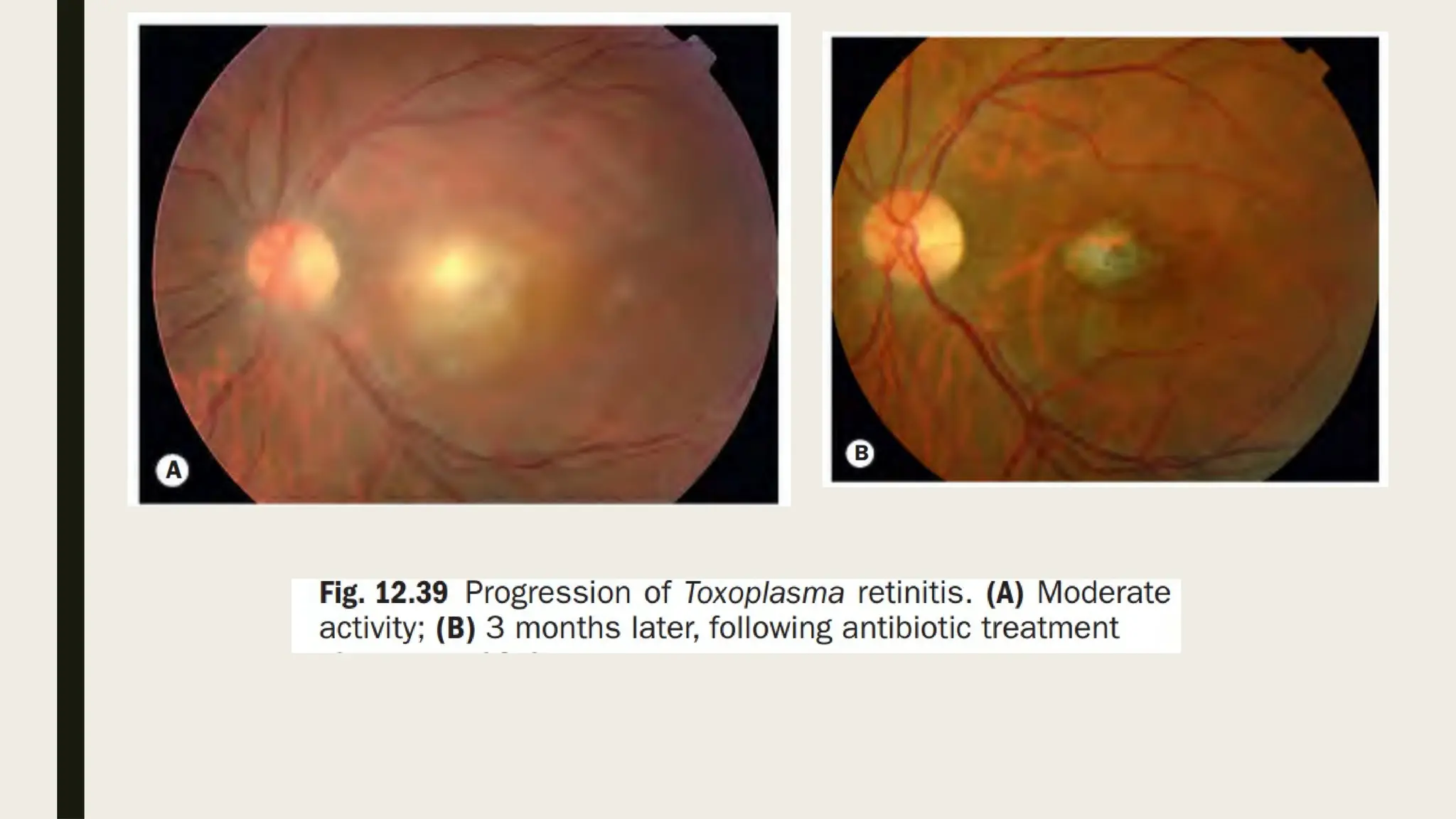 Infectious Uveitis Part 1 Pptx Ppt Upload Pptx