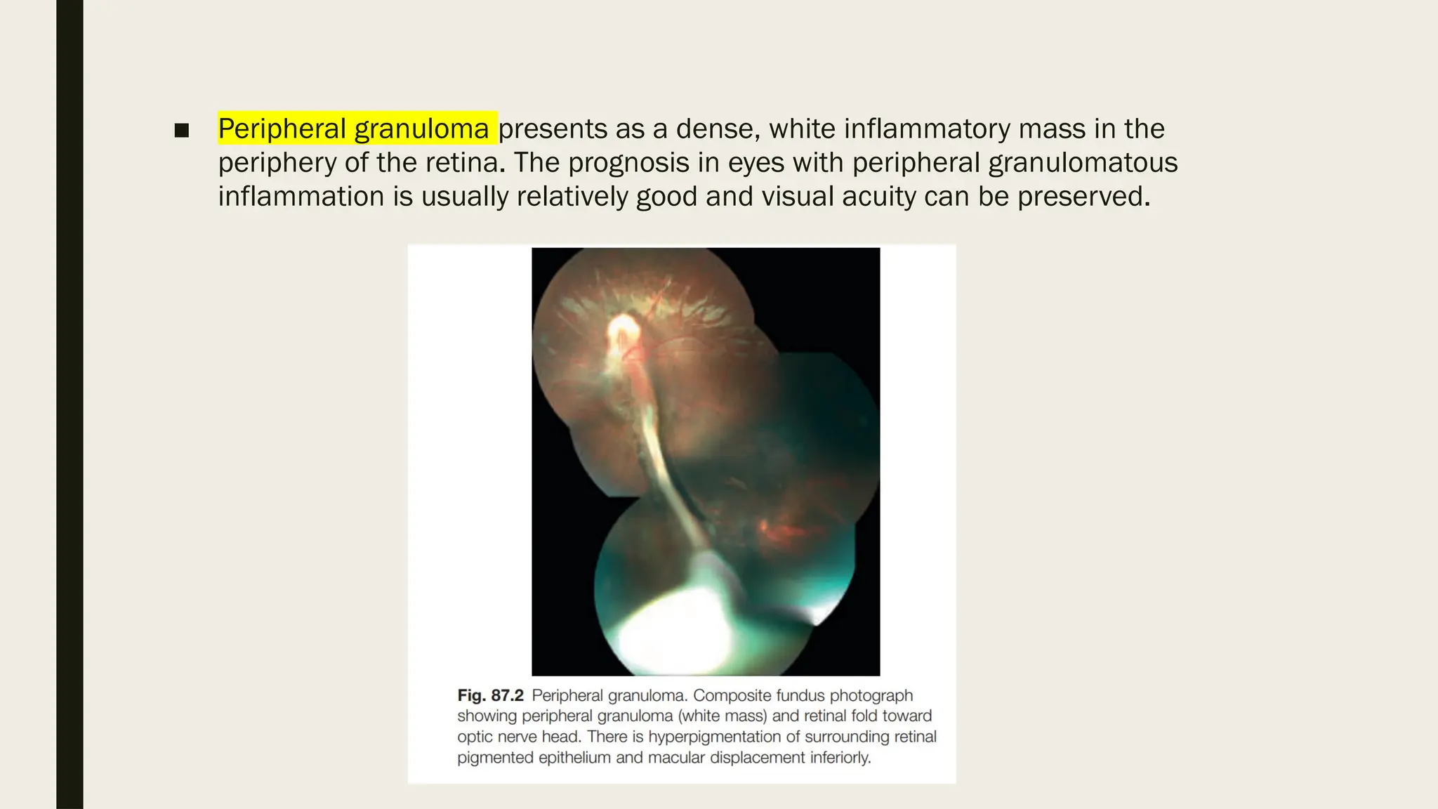 Infectious uveitis (part-1).pptx ppt upload | PPTX