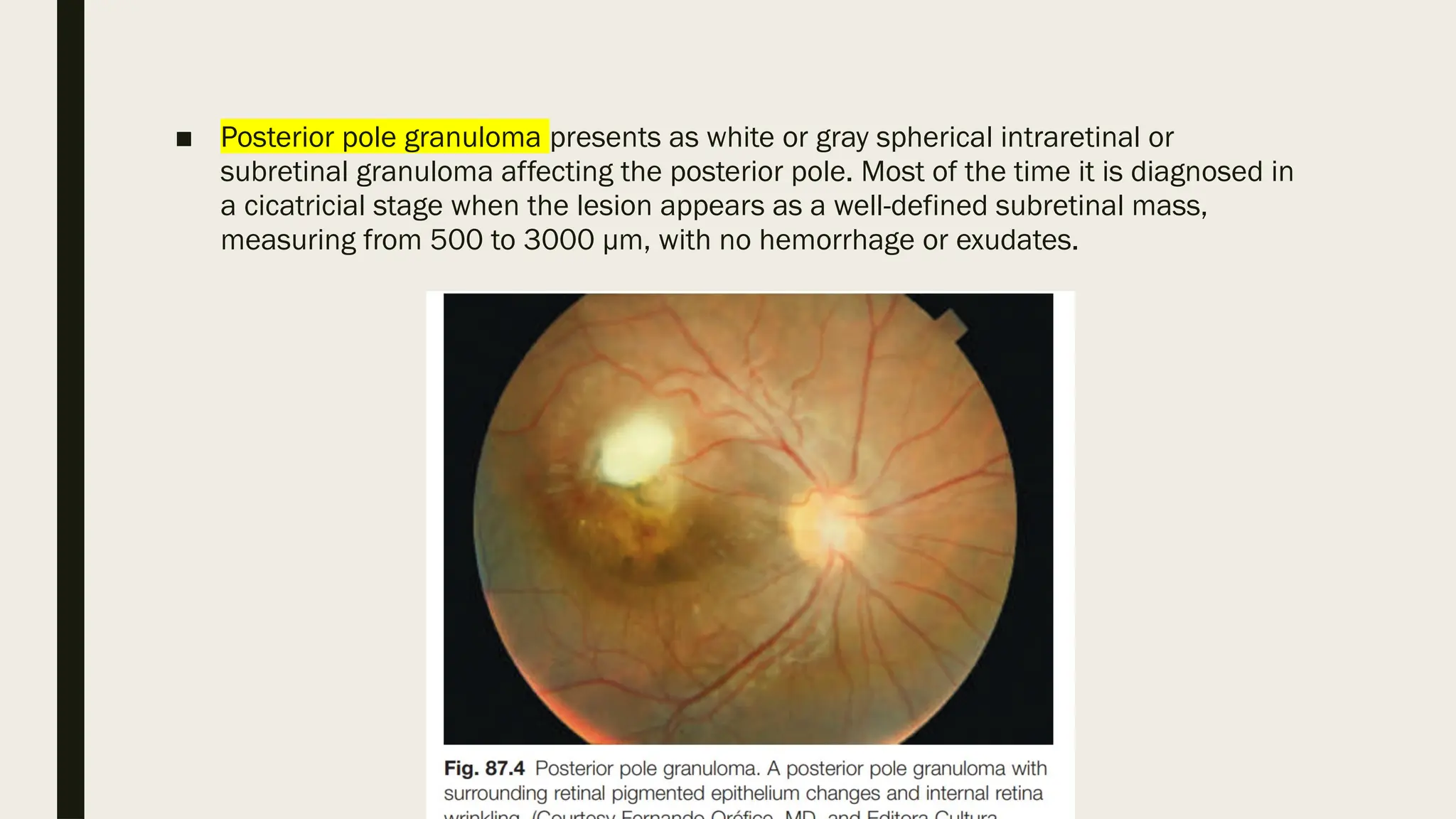Infectious uveitis (part-1).pptx ppt upload | PPTX