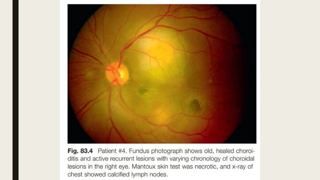 Infectious uveitis (part-1).pptx ppt upload | PPT