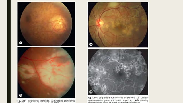 Infectious Uveitis Part 1 Pptx Ppt Upload Ppt