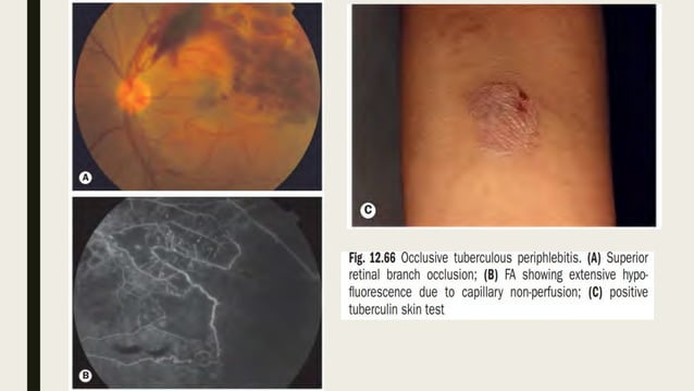 Infectious uveitis (part-1).pptx ppt upload | PPT