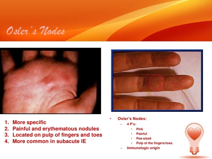 infective endocarditis krm