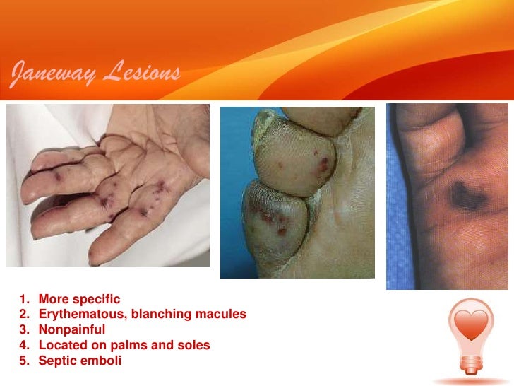 infective endocarditis krm